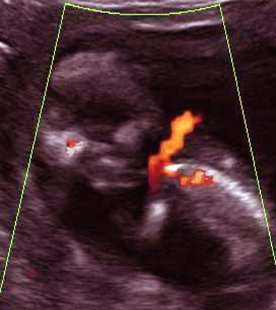 Alteraciones del cordón umbilical | Embarazo y Maternidad